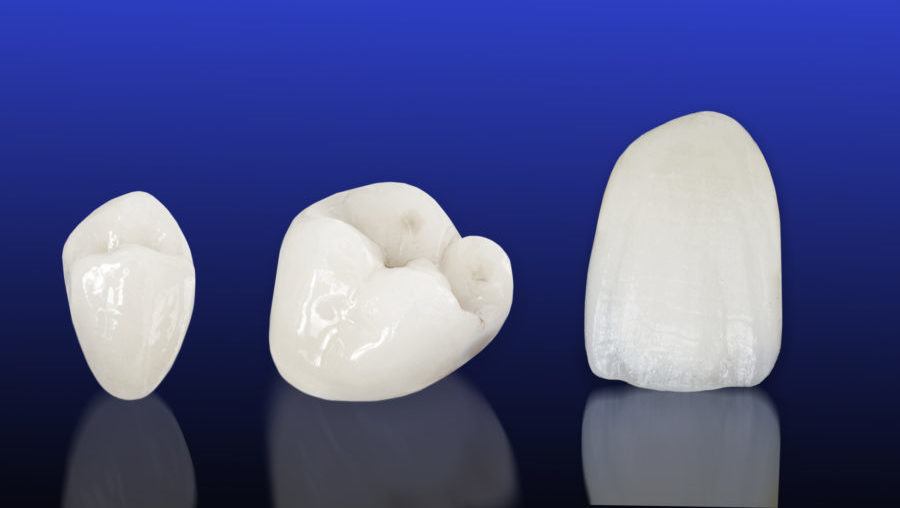 Porcelain Crowns - West Family Dentistry